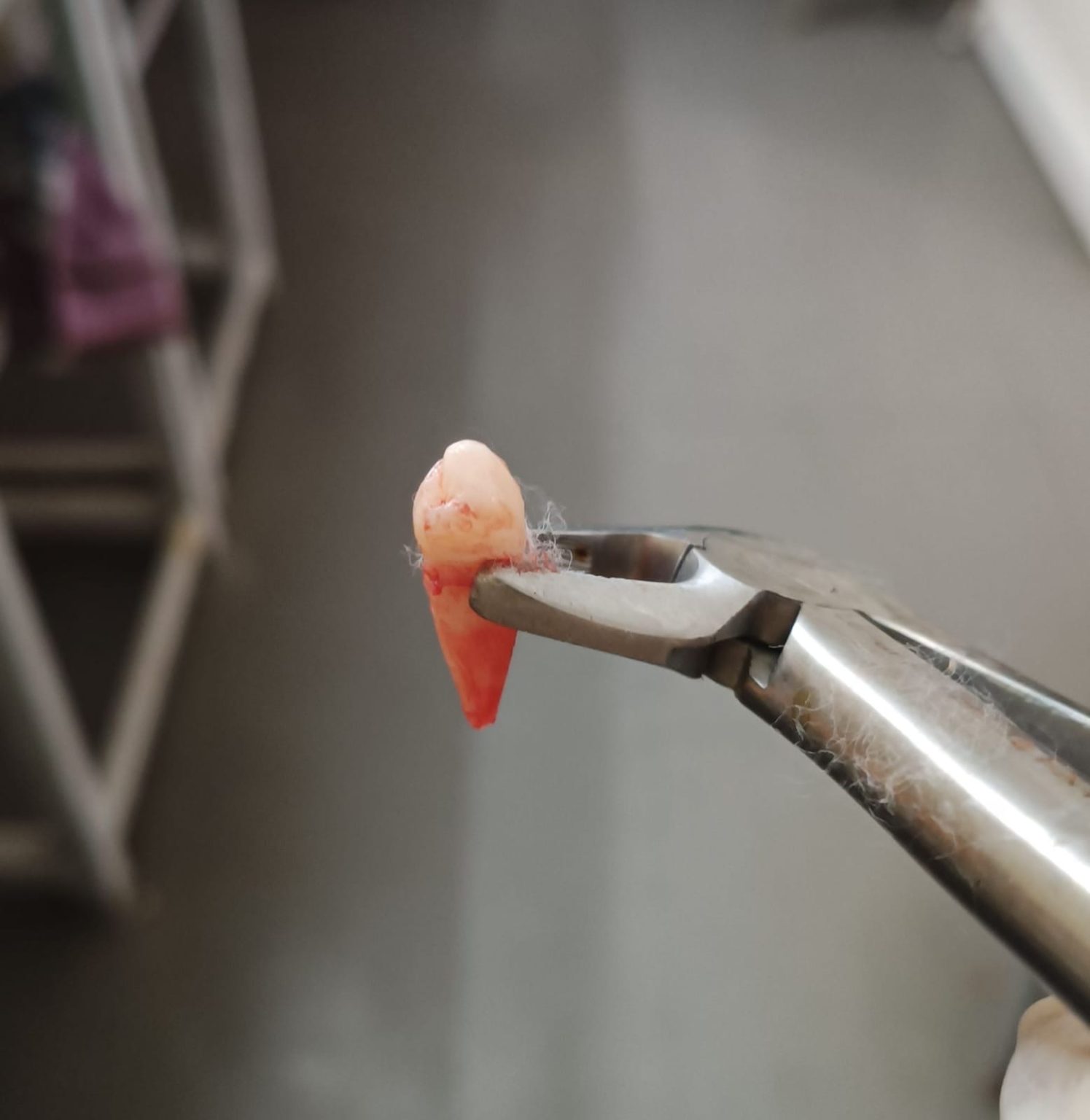 Simple vs Surgical Tooth Extraction - Differences Explained